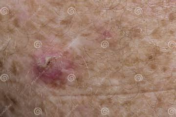 Closeup Of Scc Skin Cancer On Senior Male Leg Stock Image Image Of