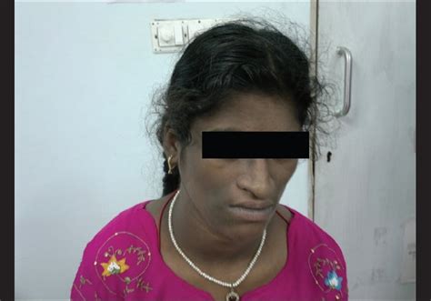 Recurrent Stroke As A Presenting Feature Of Acquired Partial