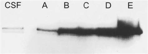 Typical Patterns Of Transferrin Isoforms Detected In Different Fluids