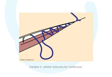 Macam Macam Teknik Suturing