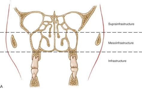 Neoplasms Of The Sinonasal Tract Clinical Tree