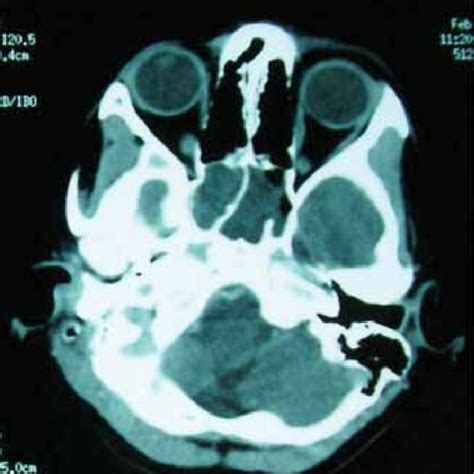 Pdf Isolated Acute Sphenoid Sinusitis As An Unexpected Cause Of Acute Headache In A 9 Year Old