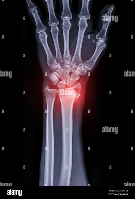 Film X Ray Wrist Joint Showing Fracture Of Ulnar Bone Isolated On Black Background Stock Photo