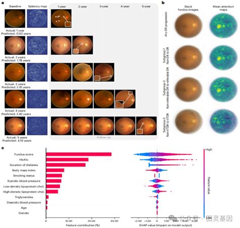 Nat Med 上海交通大学贾卫平院士团队开发ai预测糖尿病视网膜病变进展时间 知乎
