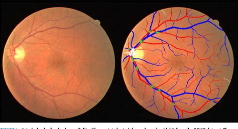 Figure 1 From Simultaneous Arteriole And Venule Segmentation Of Dual
