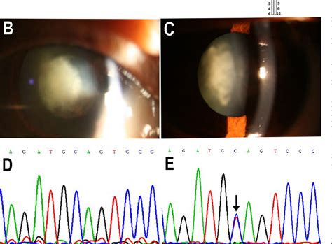 Figure 1 From A Novel Truncation Mutation In Crybb1 Associated With