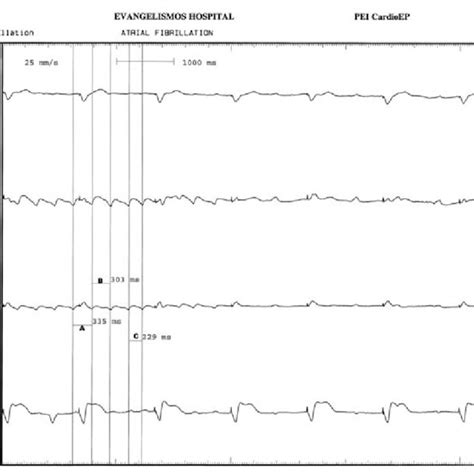 Spontaneous Conversion Of Atrial Flutter To Sinus Rhythm Prolongation