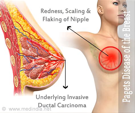 What Is Paget Disease Of The Breast Share Recipewellness Craft
