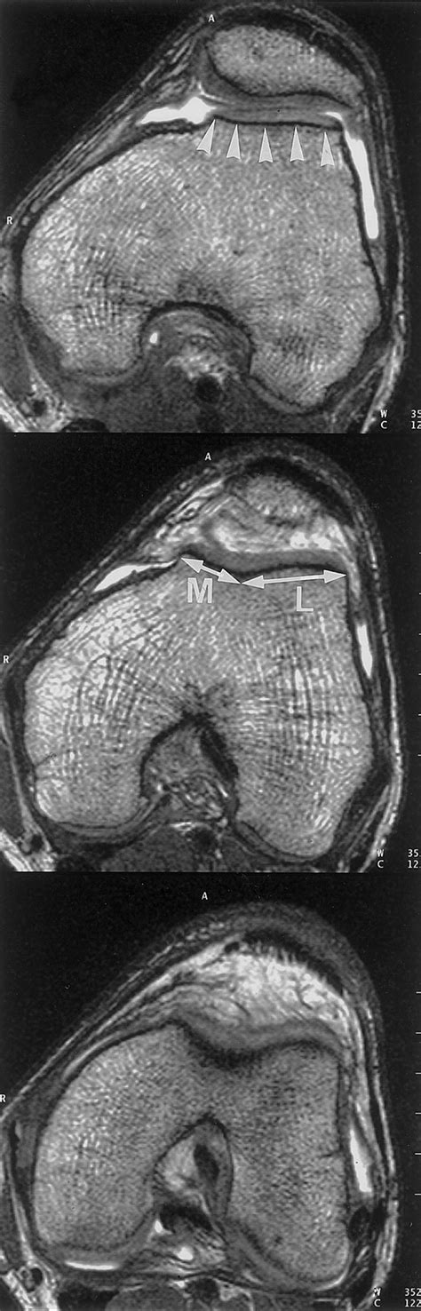 Femoral Trochlear Dysplasia Mr Findingsradiology