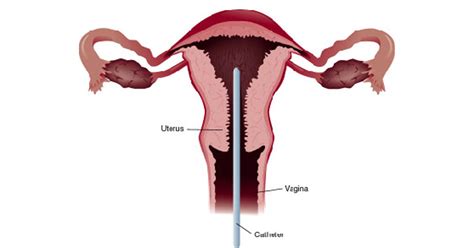 Endo Biopsy Uterus Fikohey