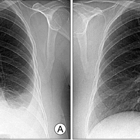 Chest X Ray Shows Left Costophrenic Angle Blunting Which Is Indicated