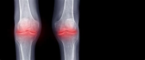 Validation Of A Patient Reported Definition For Acute Cpp Crystal Arthritis