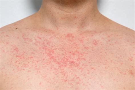 What Is Heat Rash Dermatologists Explain The Causes Ps Beauty