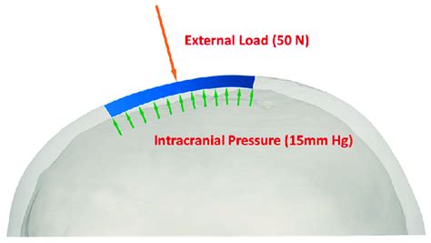 Application Of Loads To Cranial Implants Internal Load Represented By Download Scientific