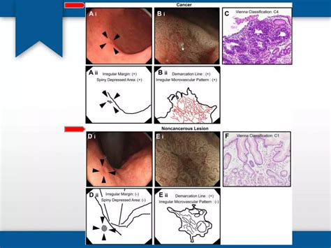 Early Gastric Cancer Pptx