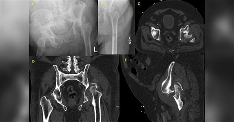 Pipkin Type Fracture In Sale Brunofuga Adv Br