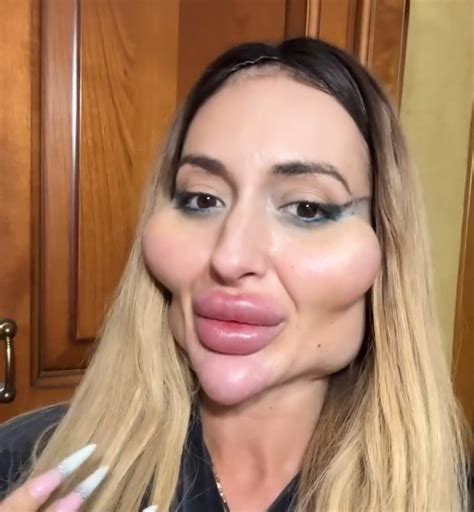 A Woman Gets Multiple Surgeries To Have “the Worlds Biggest Cheeks ” Shares Photos Bright Side