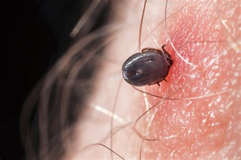 Pin On Bug Bites On Humans