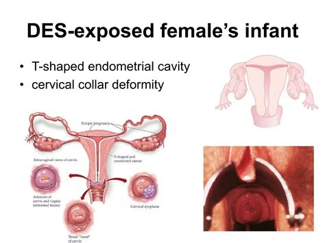 Congenital Anomalies Of Female Reproductive System Pptx