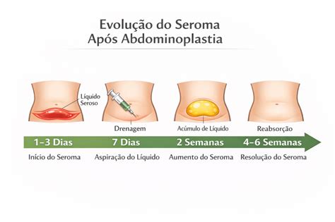 Seroma Na Abdominoplastia Como Identificar Prevenir E Tratar