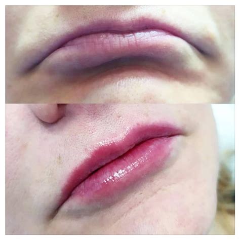 Реальные возможности аугментации губ 👄 ⠀ Гиалуроновая кислота способна ...