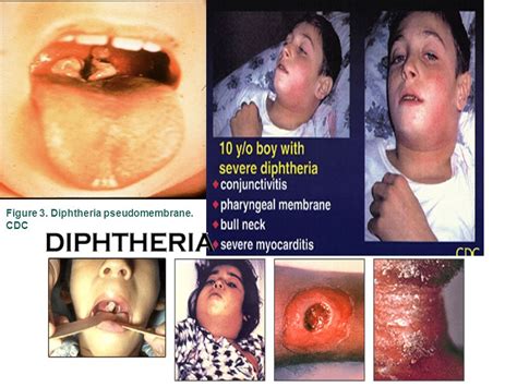 Diphtheria Pseudomembrane