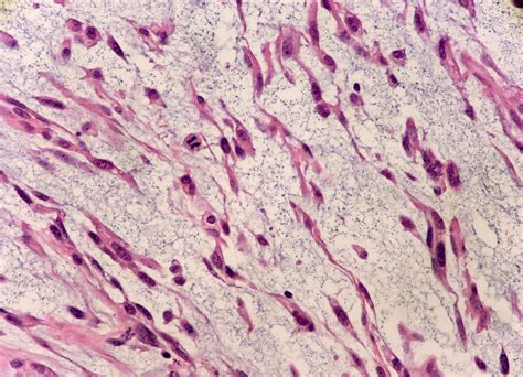 Myxofibrosarcoma Causes Symptoms And Treatment Options