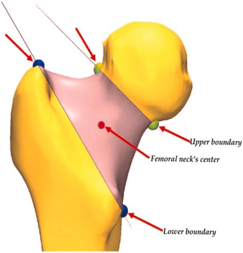 From 2d To 3d Evolution Of Evaluation Methods For Femoral Neck