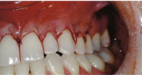Subepithelial Connective Tissue Graft The Graft Was Placed Over The Download Scientific