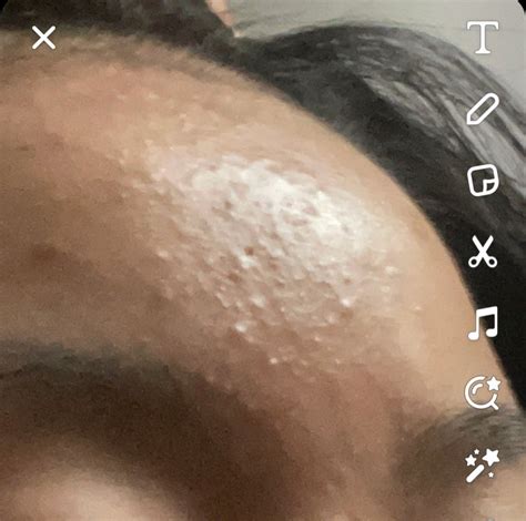 좁쌀여드름 없애는법 알려주세요ㅠㅠ 지식in