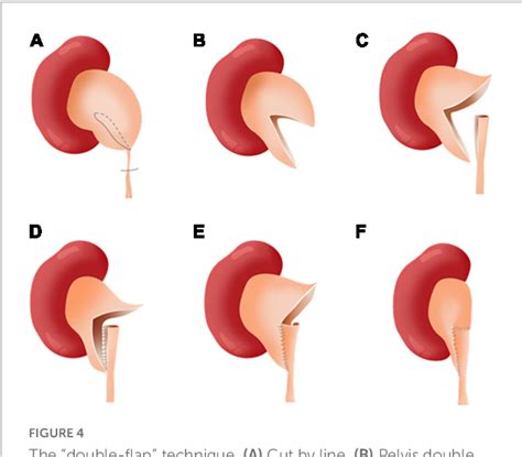 Laparoscopic Pyeloplasty Instruments At Kenneth Summers Blog