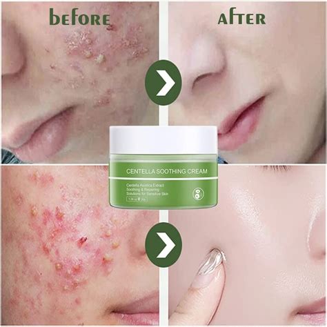 Yiylunneo Centella Crema Para Eliminar El Acné Crema Retráctil De Poros
