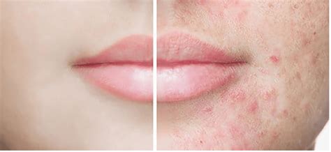 Perbedaan Purging Vs Breakout Marvee Clinic