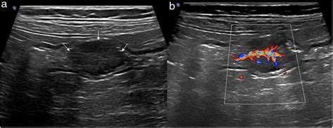 Bowel Ultrasound Examination Techniques And Normal And Pathologic