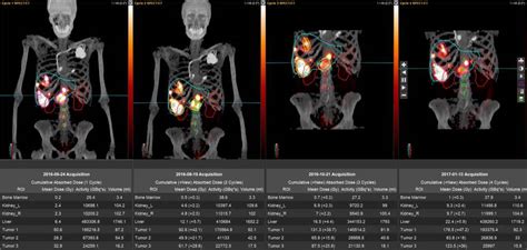 Dosimetry For Molecular Radiotherapy Isirus