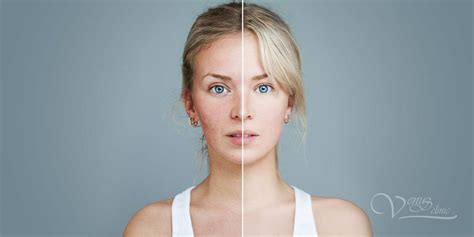 Top 10 Causes Of Cuperosis Treatment And Prophylaxy Venus Clinic En