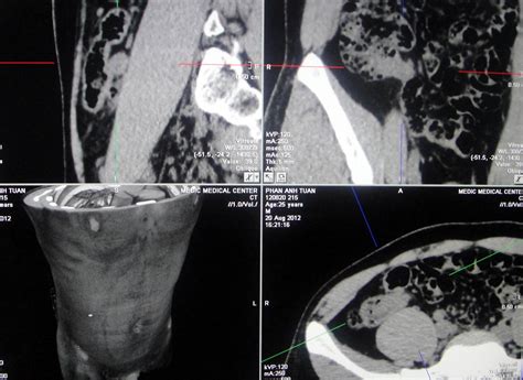 Vietnamese Medic Ultrasound Case 137 Appendix Tumor Dr Phan Thanh HẢi Dr LÝ VĂn PhÁi Dr