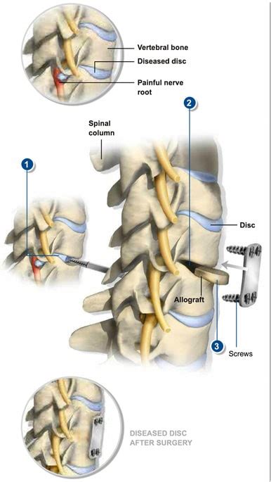 Anterior Cervical Discectomy And Fusion The Southeastern Spine Institute