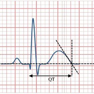 Cartoon Showing Measurement Of The QT Interval Own Work PeaBrianC Download