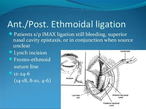Epistaxis Nose Bleed Overview And Managment
