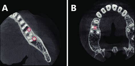 Samples Of Missed Root Canals A Missed Distobuccal Root Canals Of