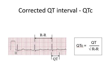 Ecg Electrocardiogram Basics And Interpretation Ppt