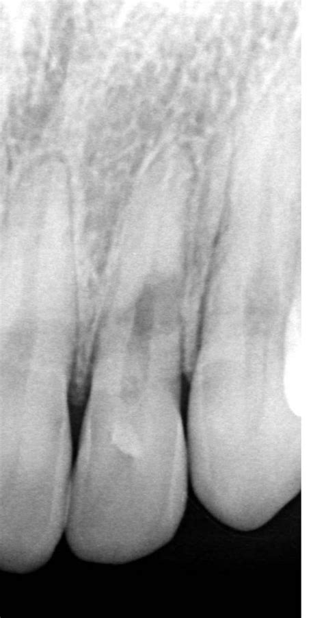 Comprehensive Diagnosis Of An Invaginated Tooth Prior To Endodontic