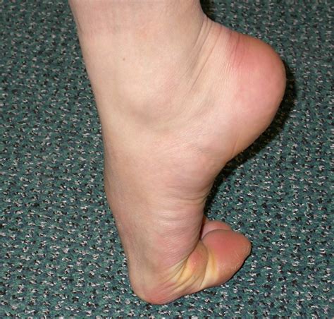 Osteoarthritis Big Toe Operation At Erin Love Blog