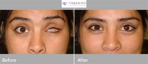 Eye Enucleation — Removal Of The Eye Oidk