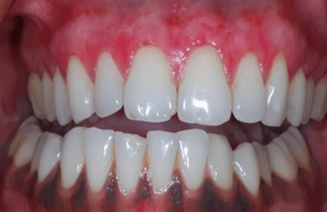 Heridas En Las Encías Clinica Dental Sonrisa Segura