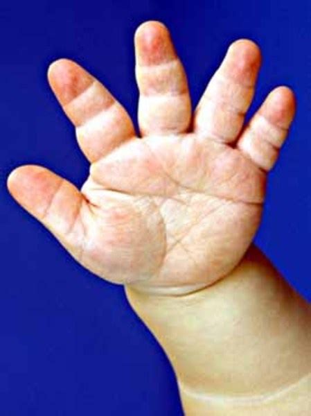 Achondroplasia Medlineplus Genetics