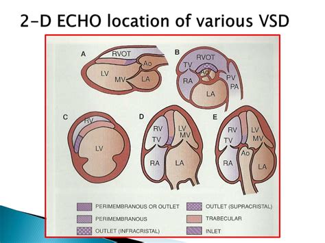 Ppt Echo Assessment Of Vsd Powerpoint Presentation Free Download Id 194552