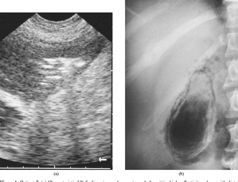 Emphysematous Cholecystitis Semantic Scholar