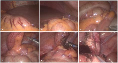 Details Of Surgical Procedure A C Exploratory Laparoscopy Confirmed Download Scientific